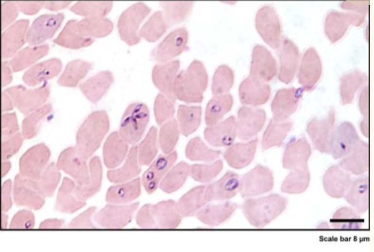 Lyme With a Side—or Two—of Babesia: The Most Common Co-Infection that ...